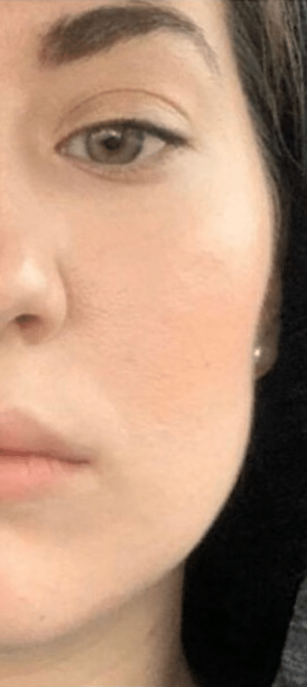 Dermal and Lip Filler Archives - Image Surgical Arts