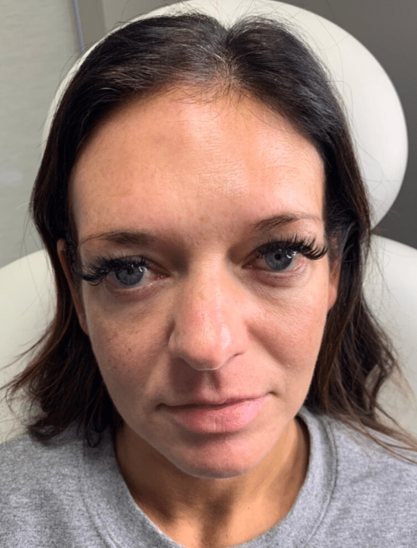 Dermal and Lip Filler Archives - Image Surgical Arts