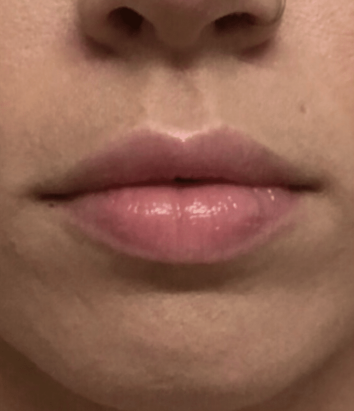 Dermal and Lip Filler Archives - Image Surgical Arts